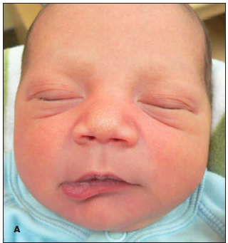 Asymmetrical Crying Facies Consultant360